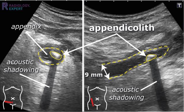 Abdominal ultrasound